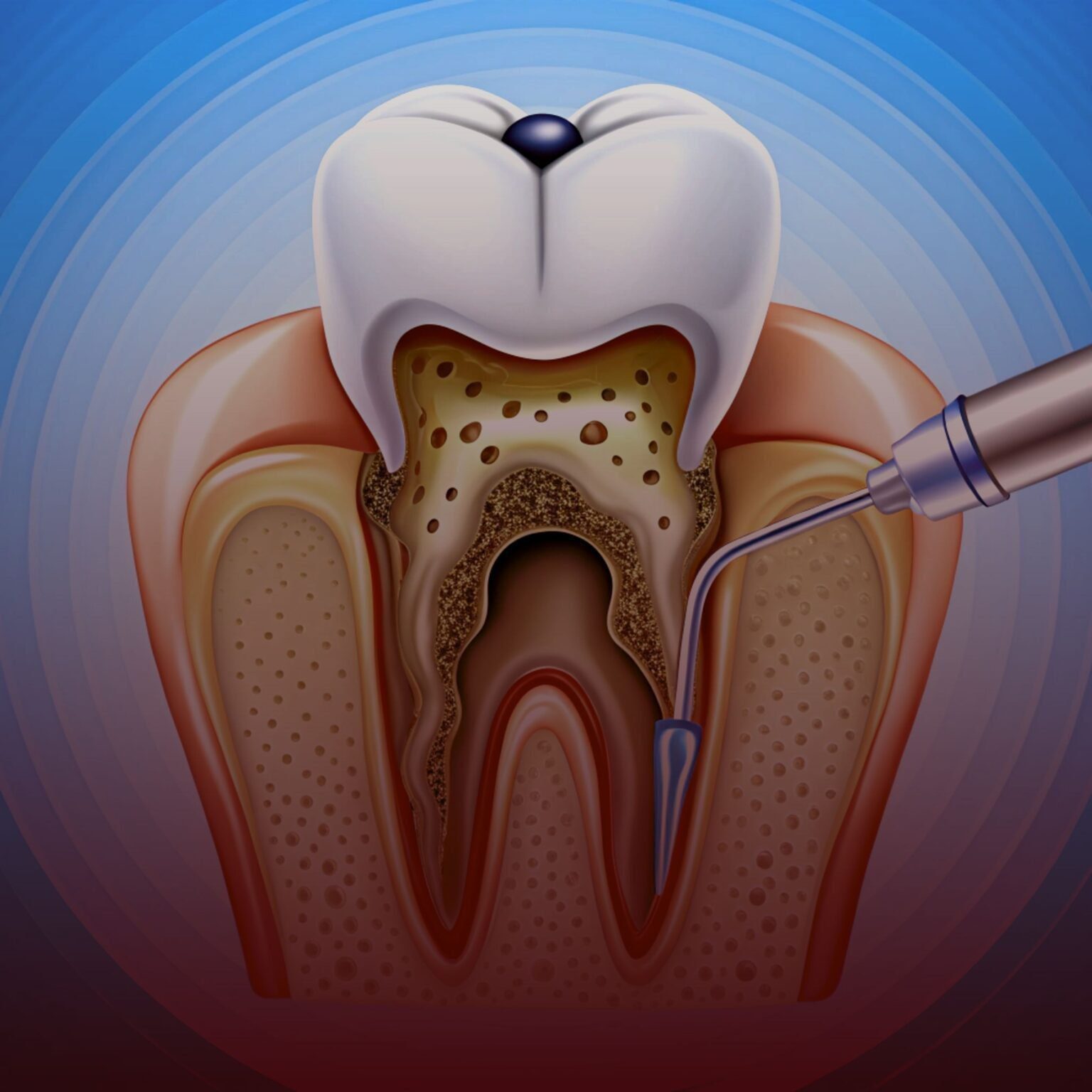 Symptoms of Failed Root Canal Treatment & Solutions | Dr. Abdurrahman ...